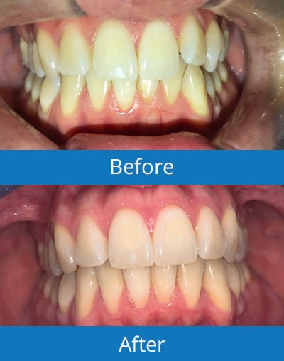 Invisalign Southsea - Teeth Straightening Portsmouth