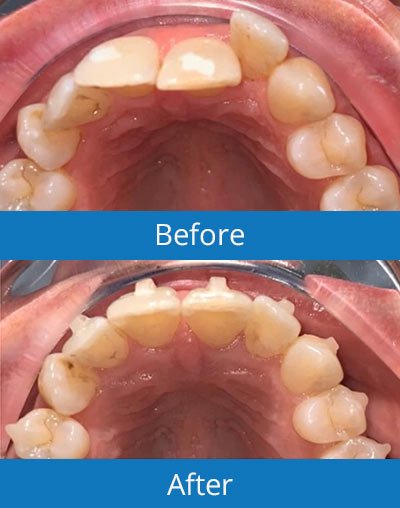 Invisalign Southsea - Teeth Straightening Portsmouth