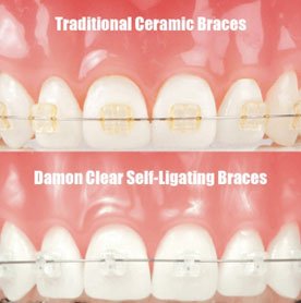 Damon Clear Braces | Southsea | Clarendon Dental Portsmouth